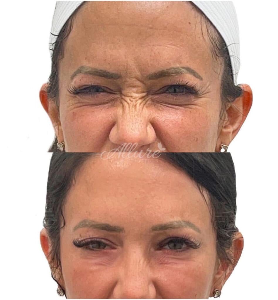 What is Dysport? | Powerful Botox Alternatives (2025)