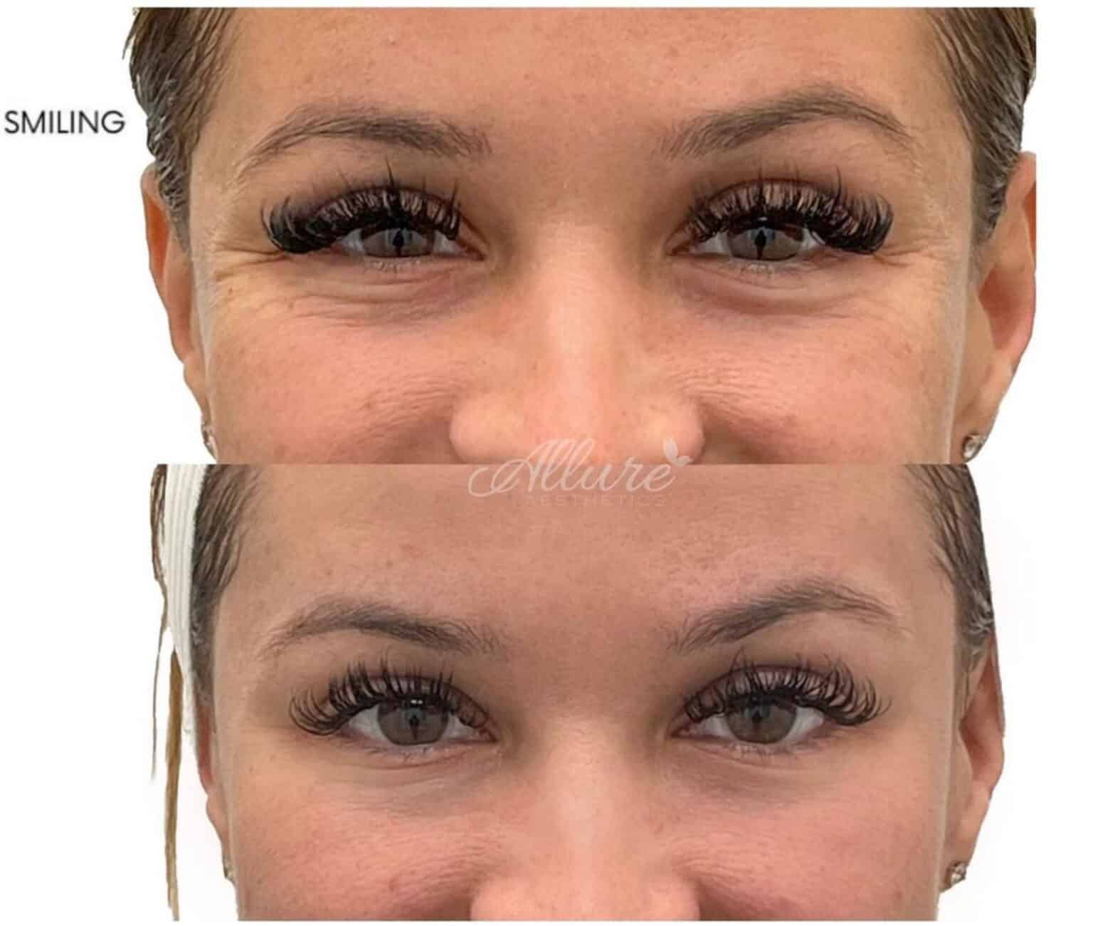 What is Dysport? | Powerful Botox Alternatives (2025)
