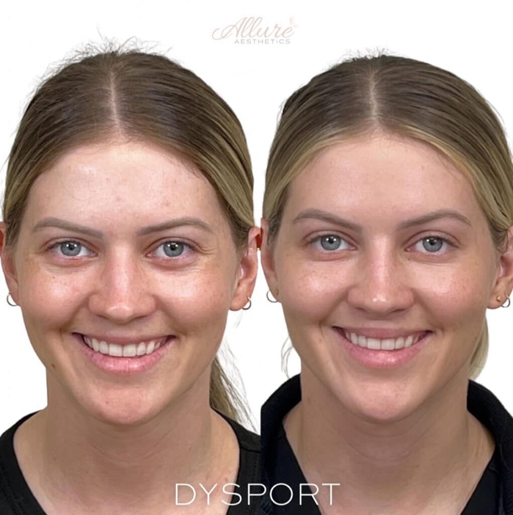Lip Flip vs Filler: Which is Best Tailored for You? (2025)