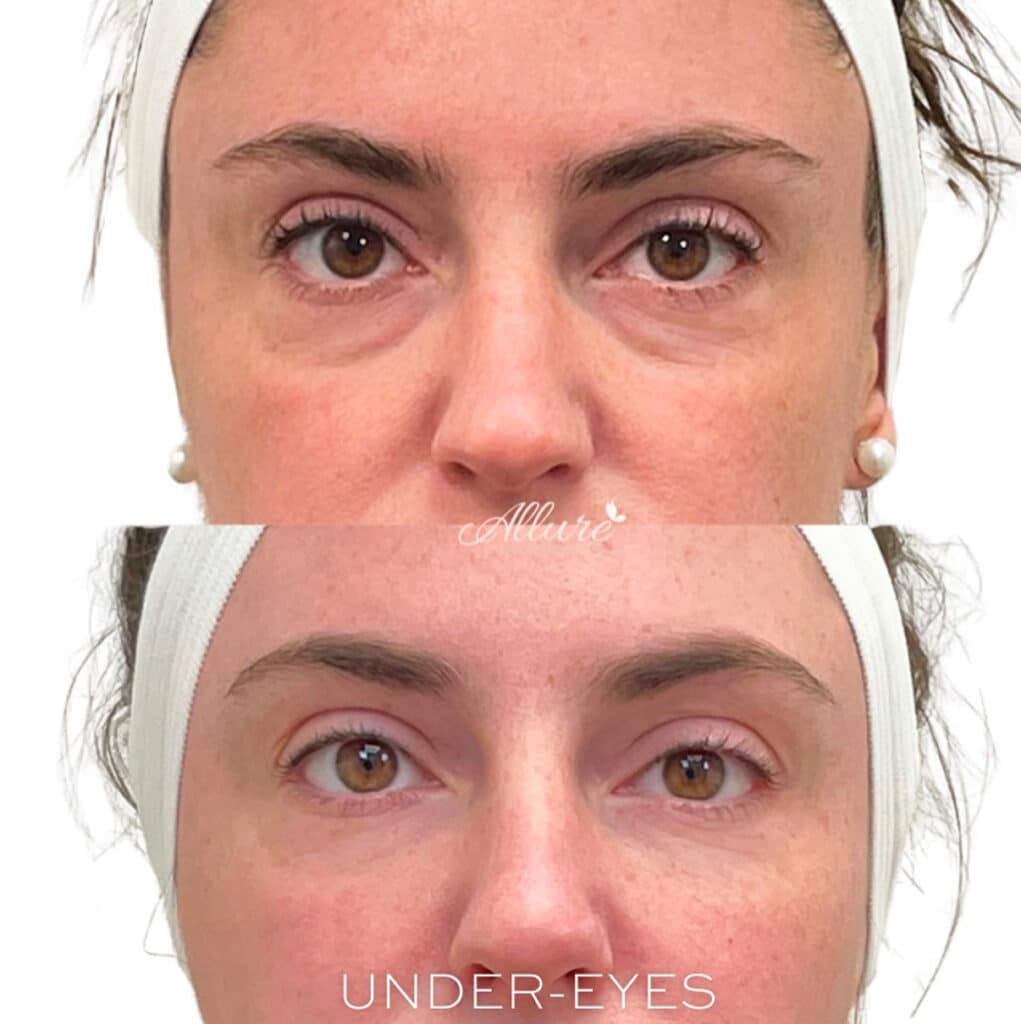 Dermal Filler for Under Eyes: Guide to Brighter Eyes (2025)