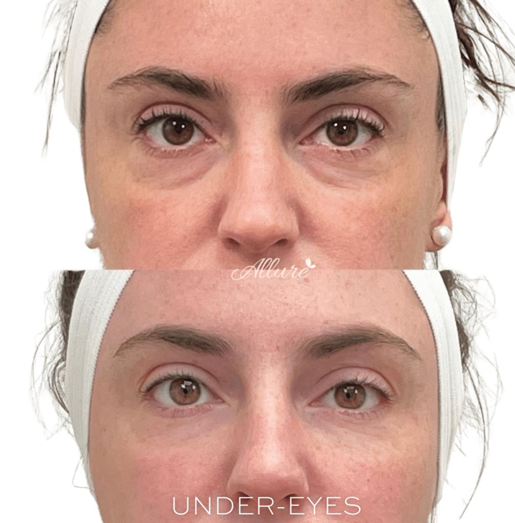 Dark Circles Under Eyes: 5 Causes & Best Treatments
